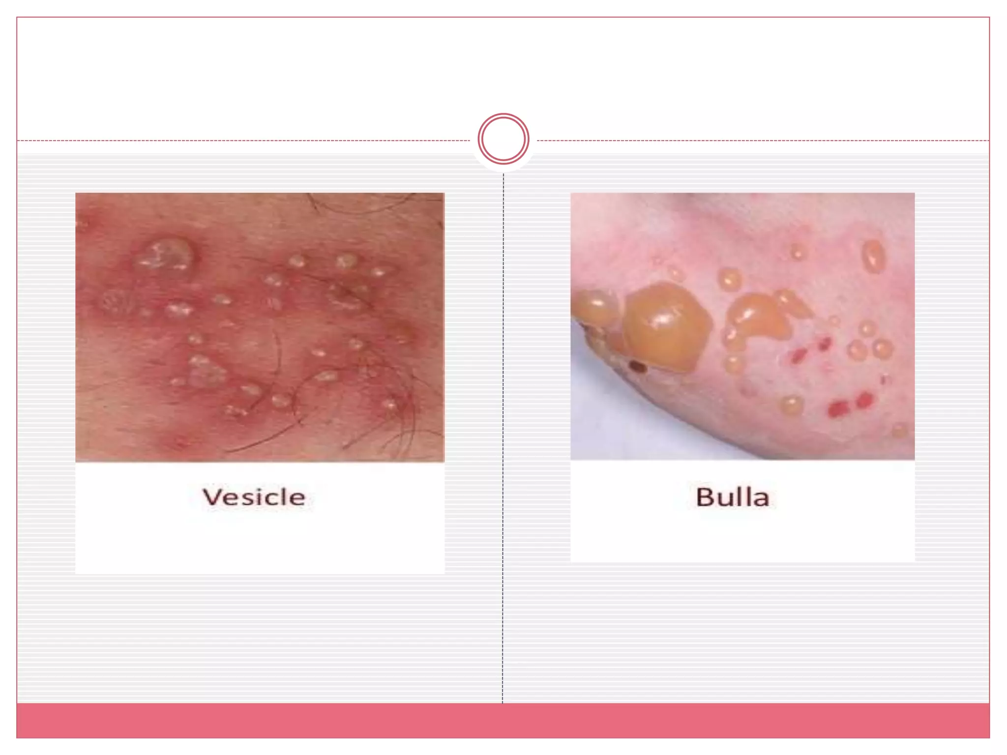 Vesiculobullous disease | PPTX