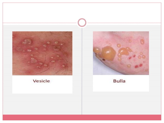 Vesiculobullous disease | PPTX | Skin and Dermatology | Diseases and ...
