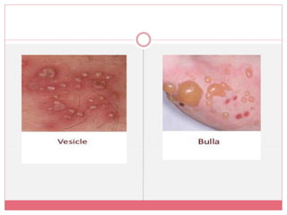 Vesicle Bulla