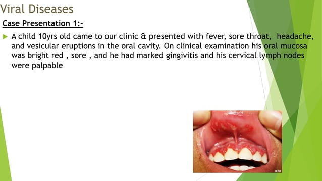 Vesiculo bullous diseases | PPTX | Skin and Dermatology | Diseases and ...