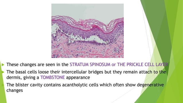 Vesiculo bullous diseases | PPTX | Skin and Dermatology | Diseases and ...