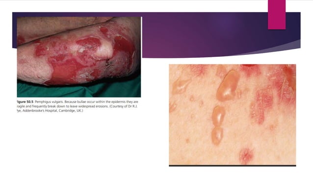 VESICULOBULLOUS DISORDERS- INTRAEPIDERMAL SPLIT | PPT