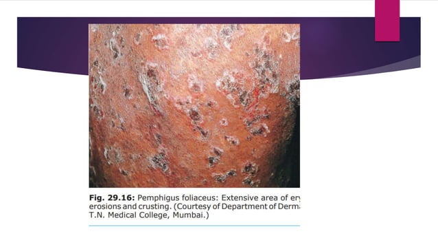 VESICULOBULLOUS DISORDERS- INTRAEPIDERMAL SPLIT | PPT