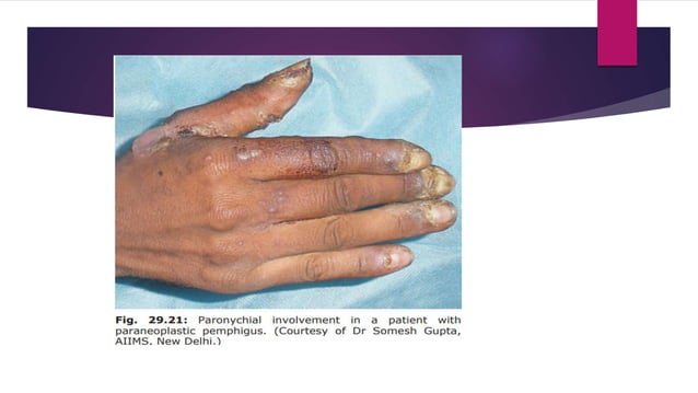 VESICULOBULLOUS DISORDERS- INTRAEPIDERMAL SPLIT | PPT