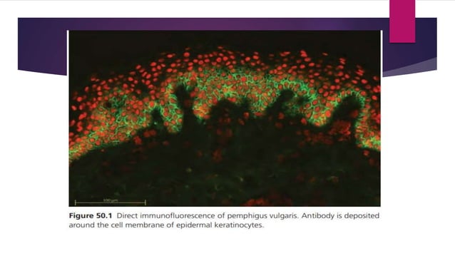 VESICULOBULLOUS DISORDERS- INTRAEPIDERMAL SPLIT | PPT
