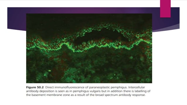 VESICULOBULLOUS DISORDERS- INTRAEPIDERMAL SPLIT | PPT