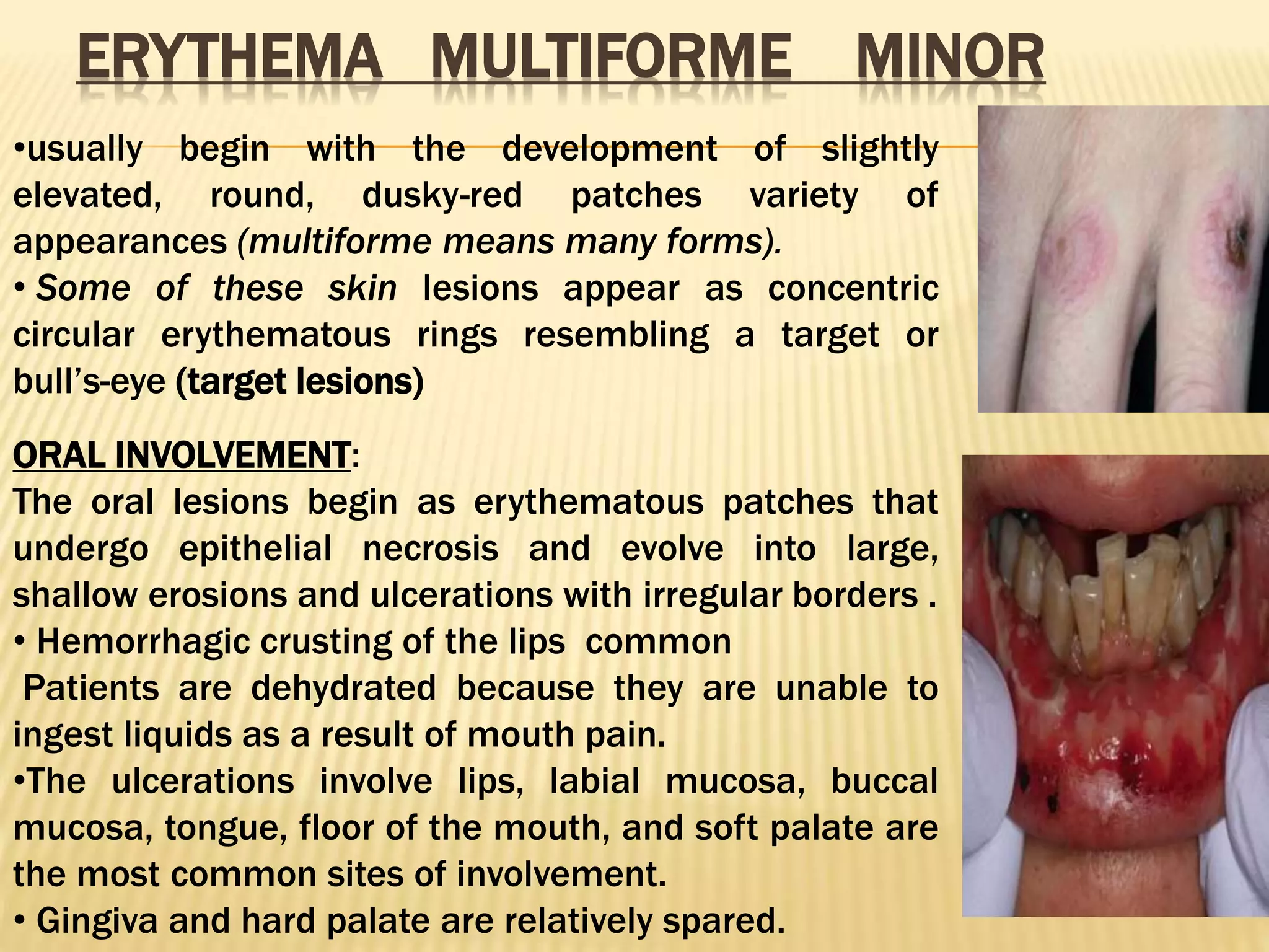 ORAL VESICULOBULLOUS LESION | PPTX