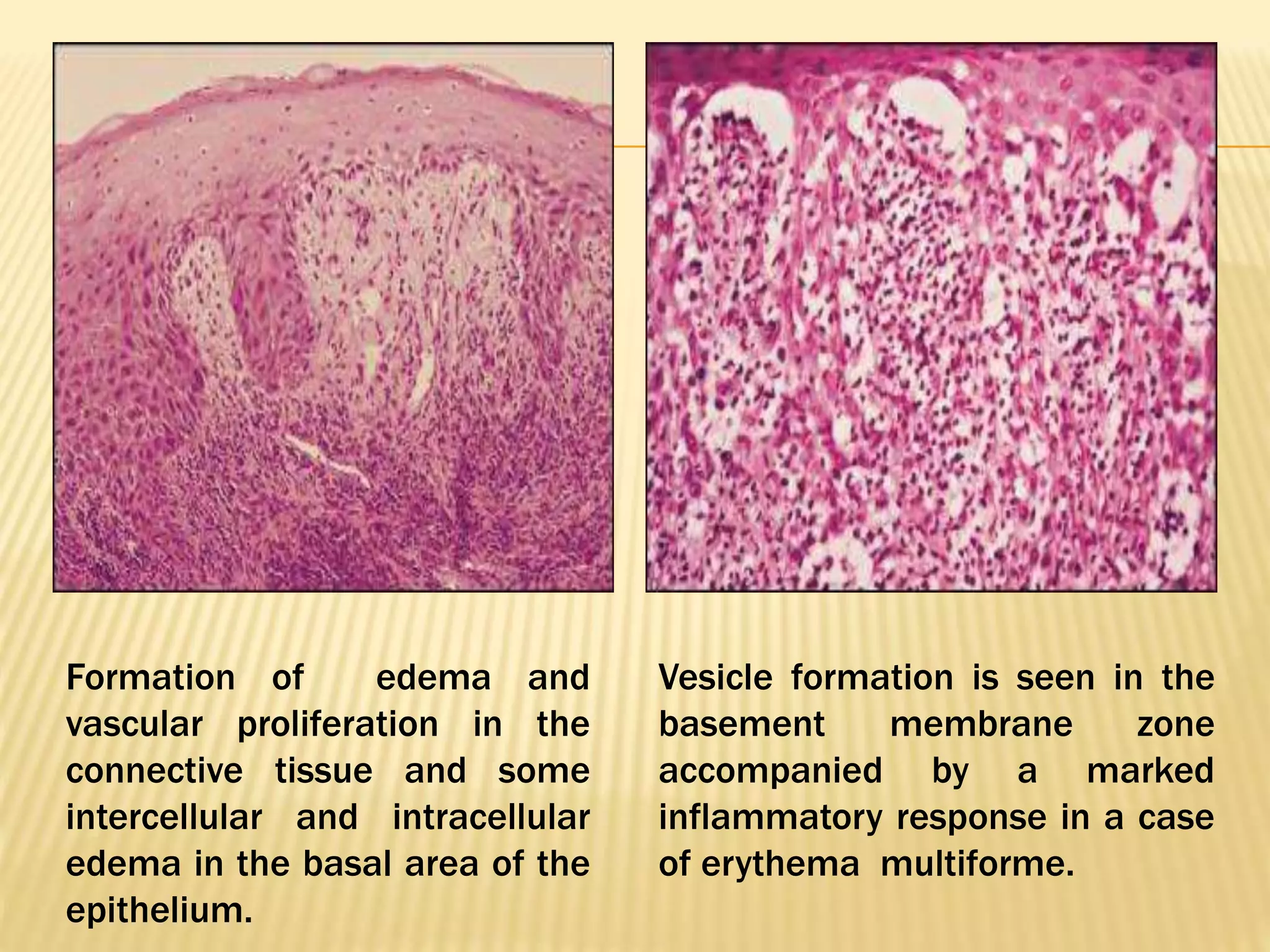 ORAL VESICULOBULLOUS LESION | PPTX