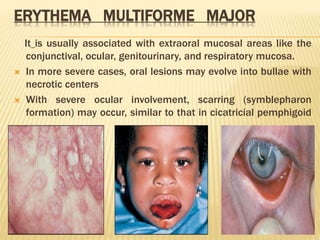 ORAL VESICULOBULLOUS LESION | PPTX