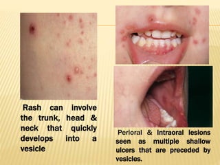 ORAL VESICULOBULLOUS LESION | PPTX