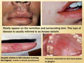 ORAL VESICULOBULLOUS LESION | PPTX