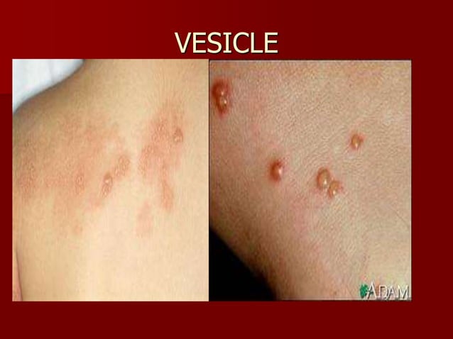 Vesiculobullous lesions dr.aseem mohammed