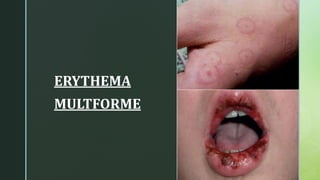 VESICULO BULLOUS LESIONS | PPTX