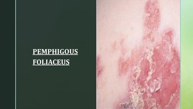 VESICULO BULLOUS LESIONS | PPTX