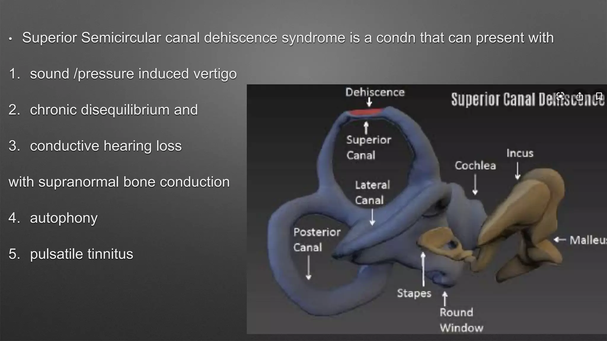Vesti. migraine, neuronitis, ssc dehiscence | PPTX