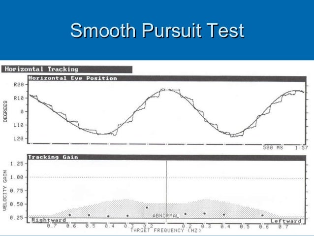 vertigo and the Vestibular system