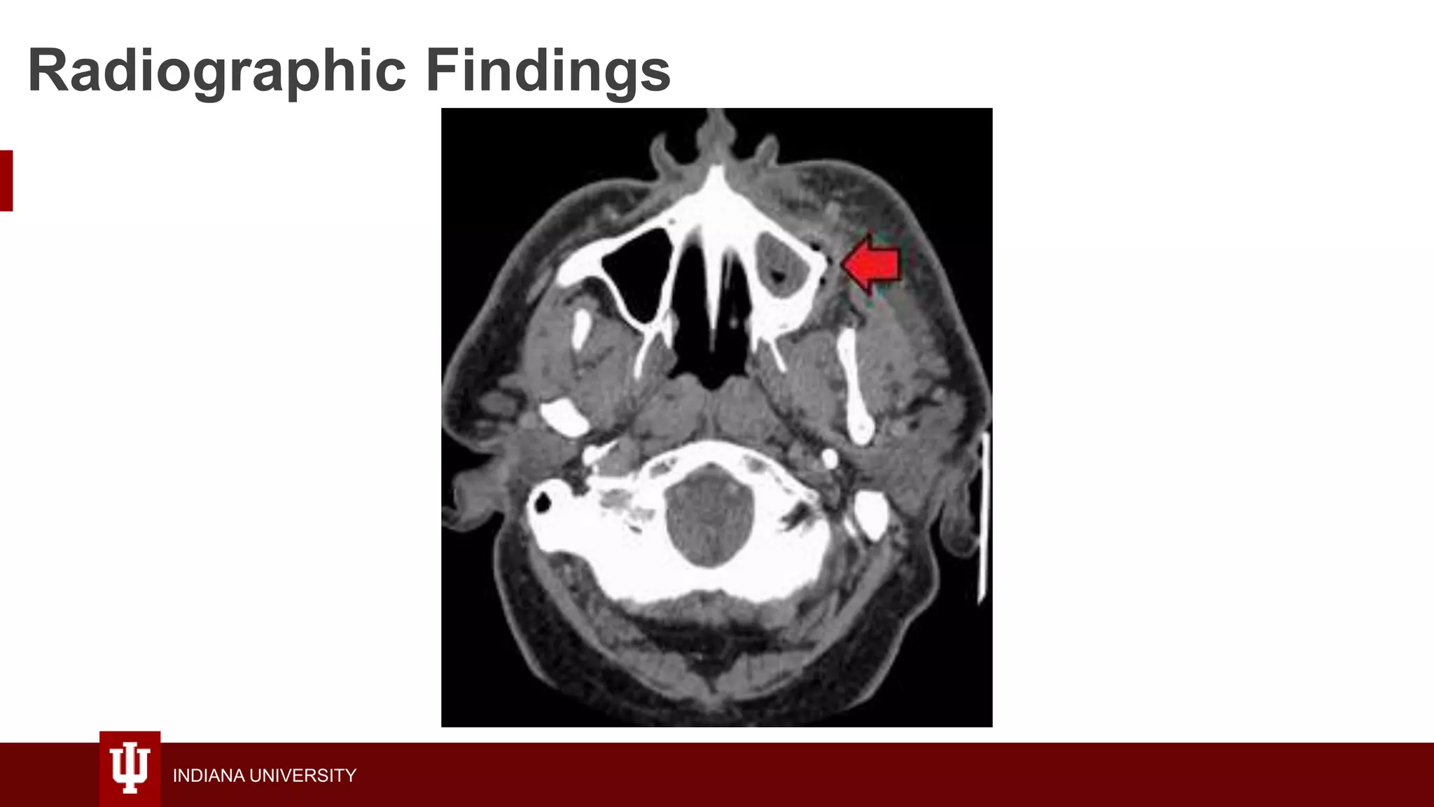 Vestibular Abscess.pptx | Ear, Nose and Throat Conditions | Diseases ...