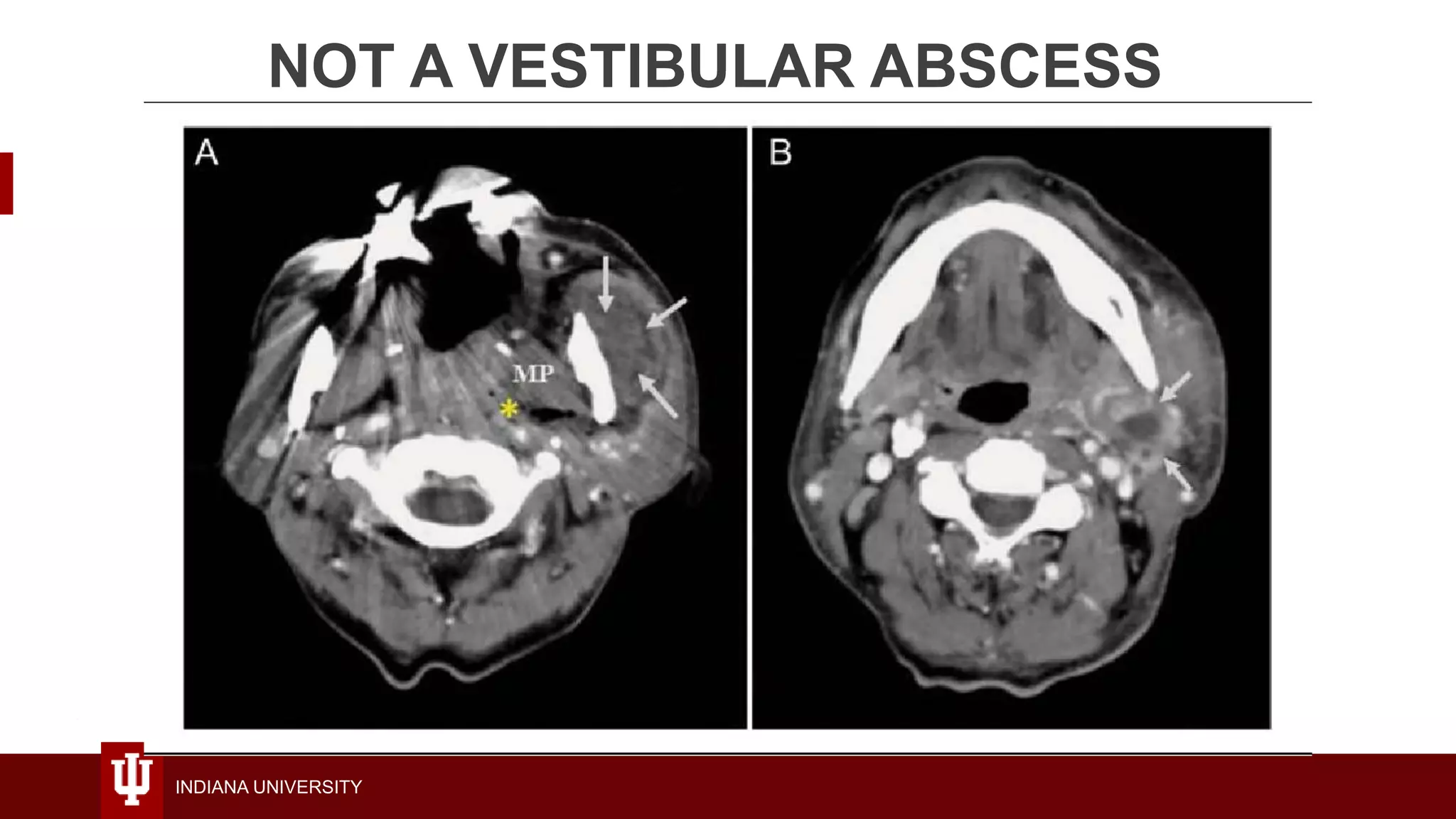 Vestibular Abscess.pptx | Ear, Nose and Throat Conditions | Diseases ...