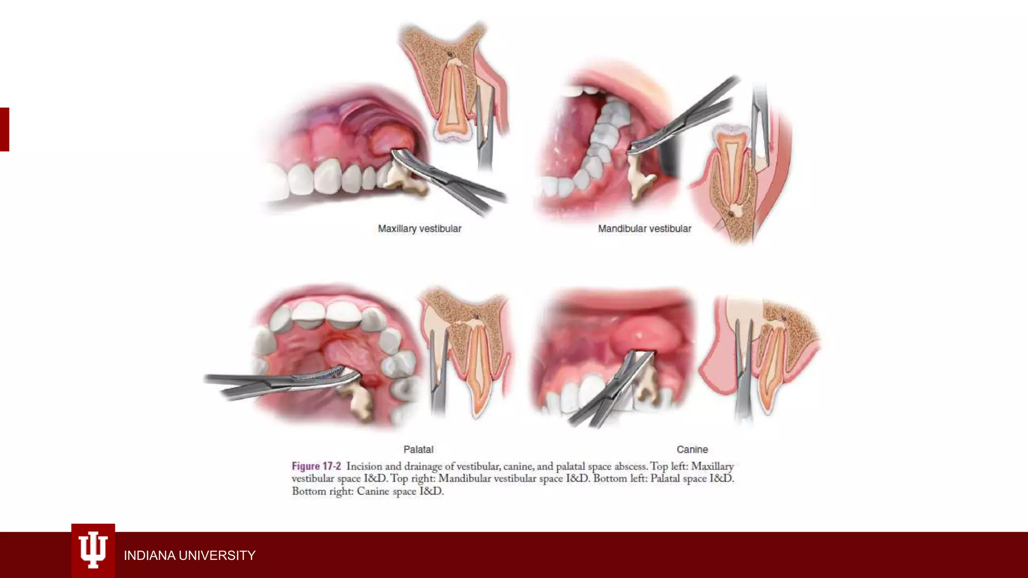 Vestibular Abscess.pptx | Ear, Nose and Throat Conditions | Diseases ...