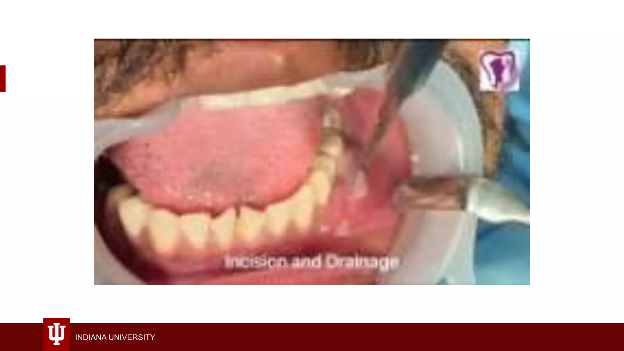 Vestibular Abscess.pptx | Ear, Nose and Throat Conditions | Diseases ...