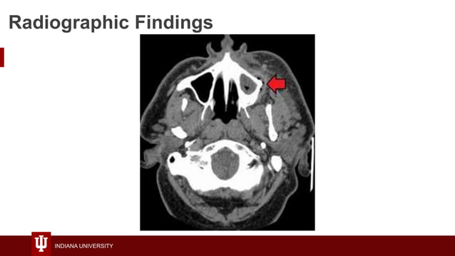 Vestibular Abscess.pptx | Ear, Nose and Throat Conditions | Diseases ...