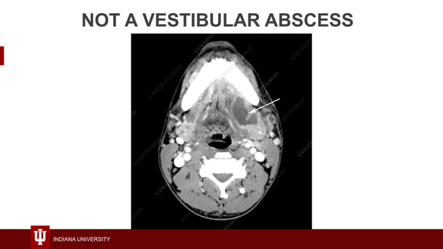 Vestibular Abscess.pptx | Ear, Nose and Throat Conditions | Diseases ...