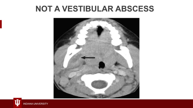 Vestibular Abscess.pptx | Ear, Nose and Throat Conditions | Diseases ...