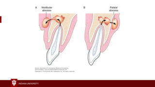 Vestibular Abscess.pptx