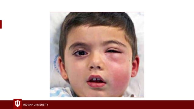 Vestibular Abscess.pptx