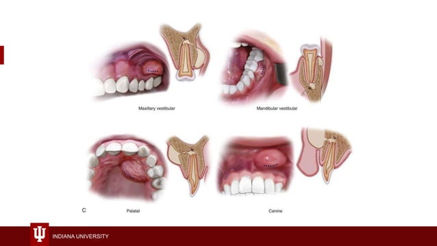 Vestibular Abscess.pptx