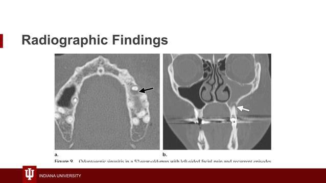 Vestibular Abscess.pptx