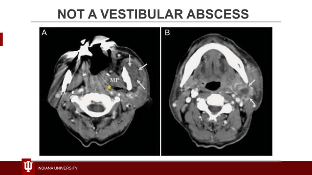 Vestibular Abscess.pptx