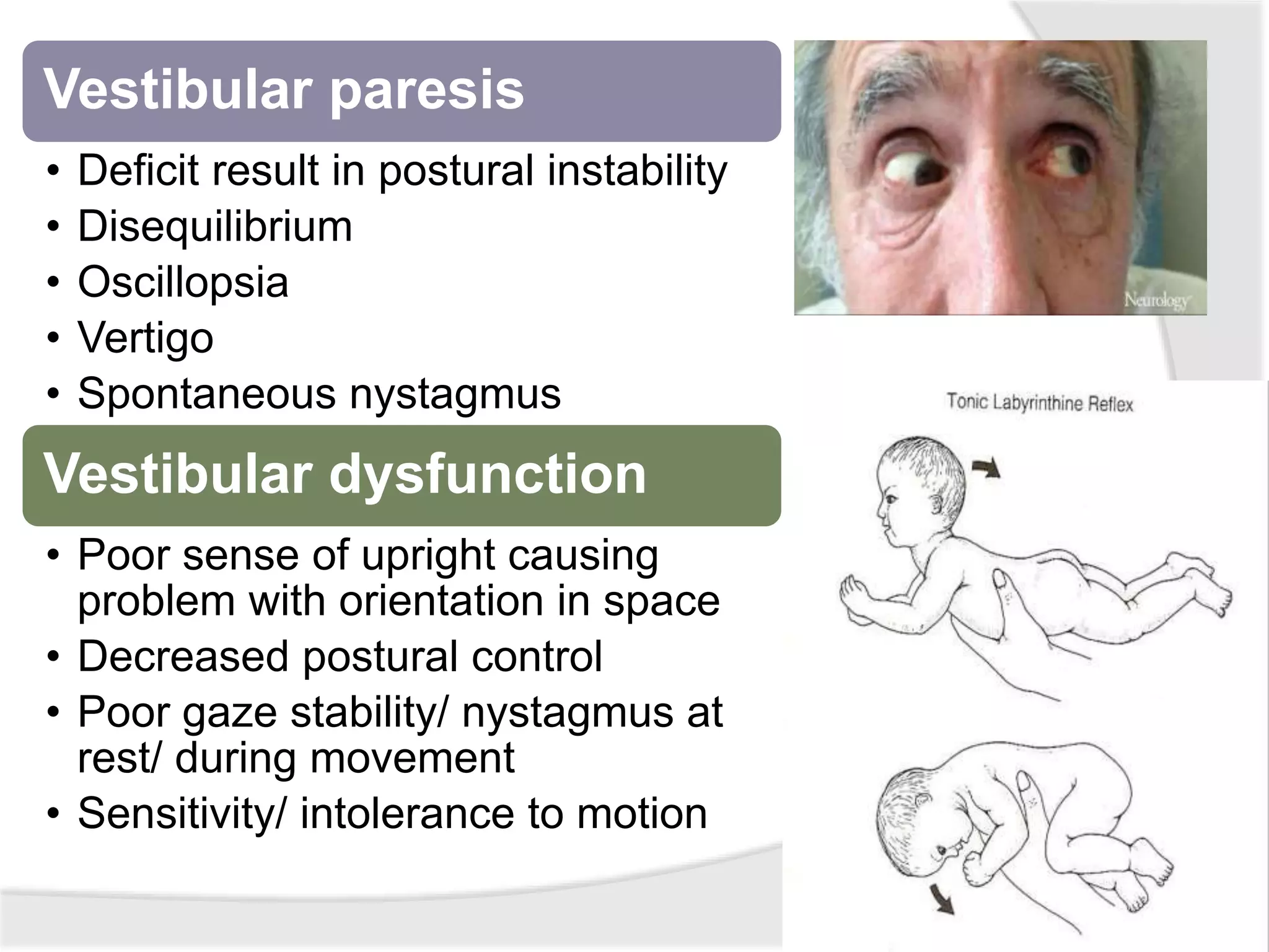 Vestibular disorder 1 (1).pptx