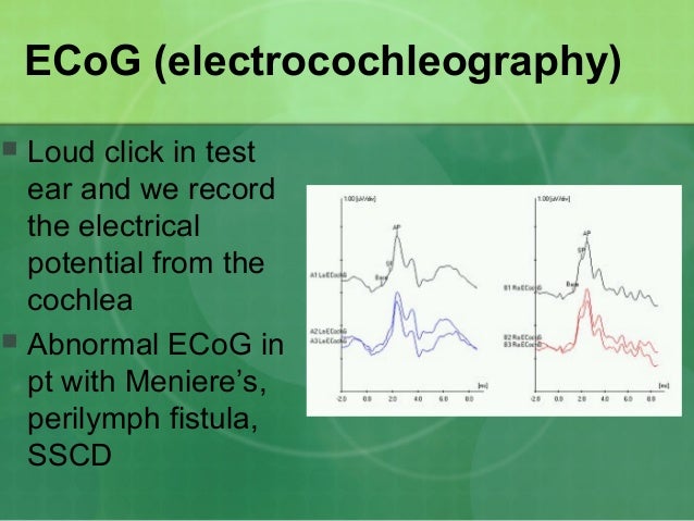 Vestibular disorders