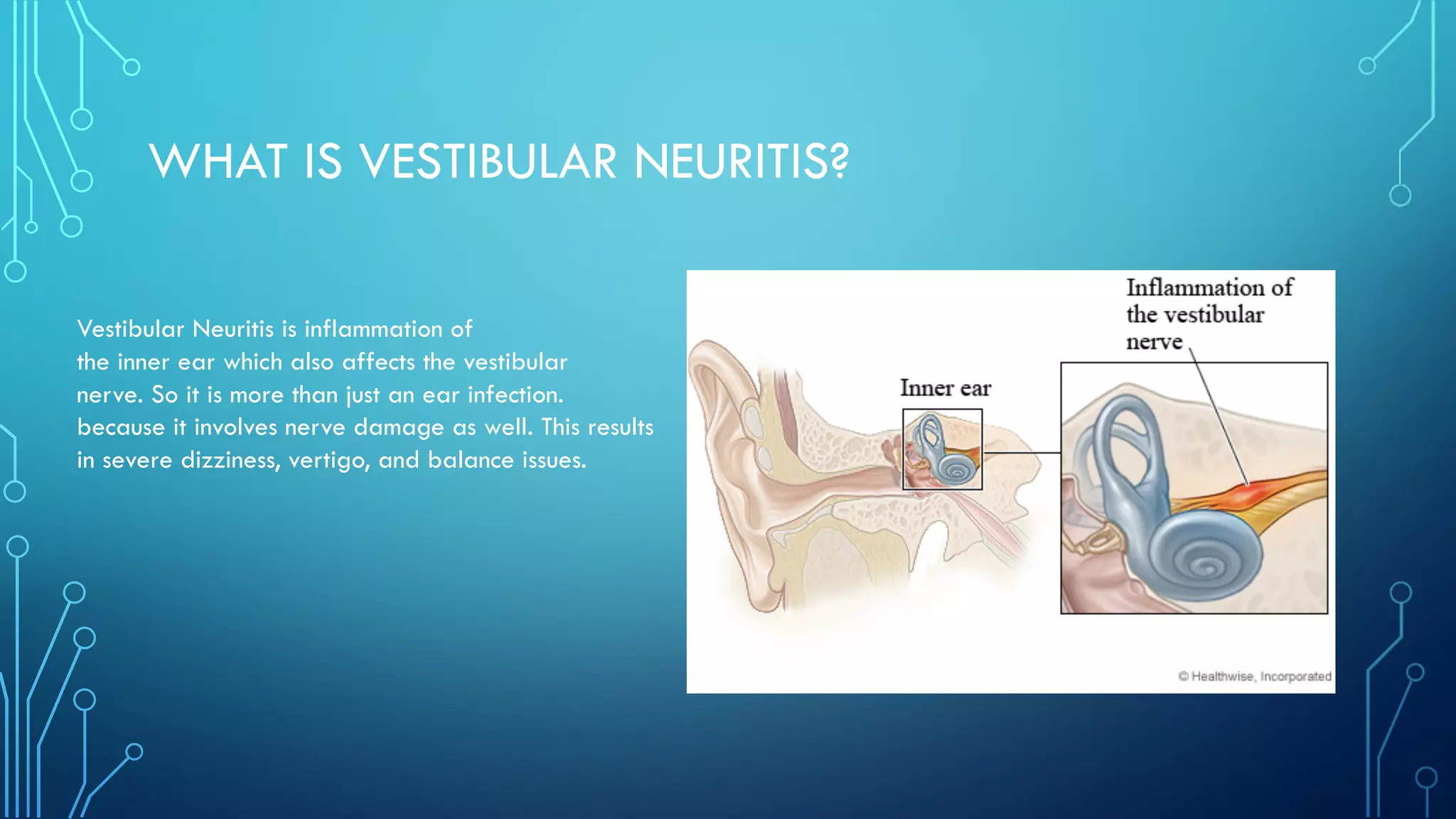 Vestibular neuritis | PDF