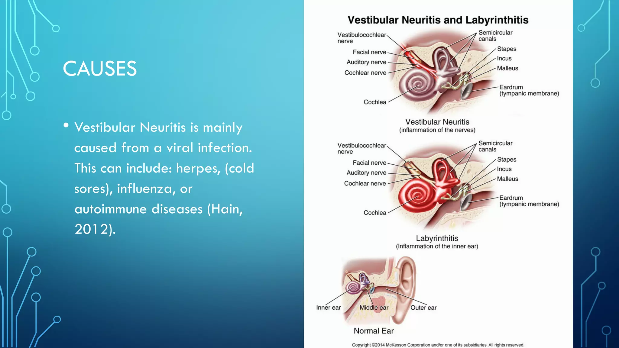 Vestibular neuritisslideshow | PDF