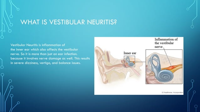 Vestibular neuritisslideshow | PPT