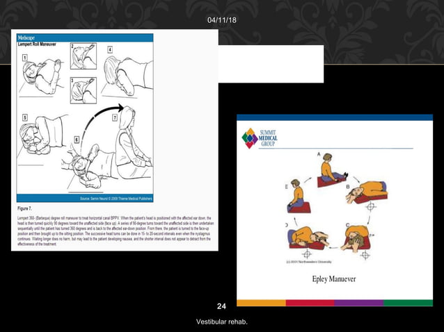 Vestibular rehabilitation | PPT