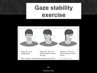 Vestibular rehabilitation | PPT