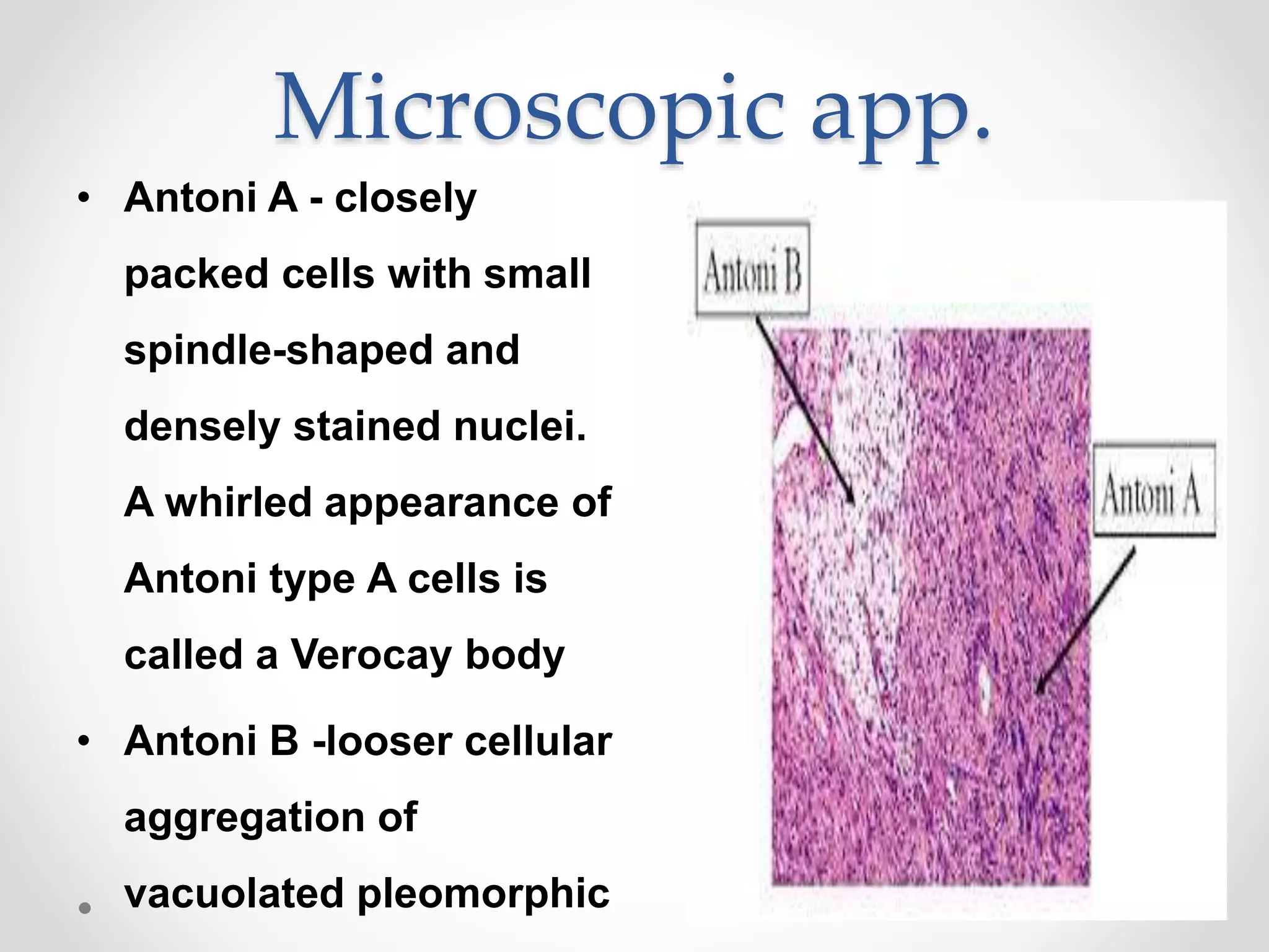 Vestibular schwannoma chiru | PPTX