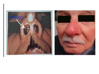 Vestibulitis_and_Furunculitis_Bordered.pptx