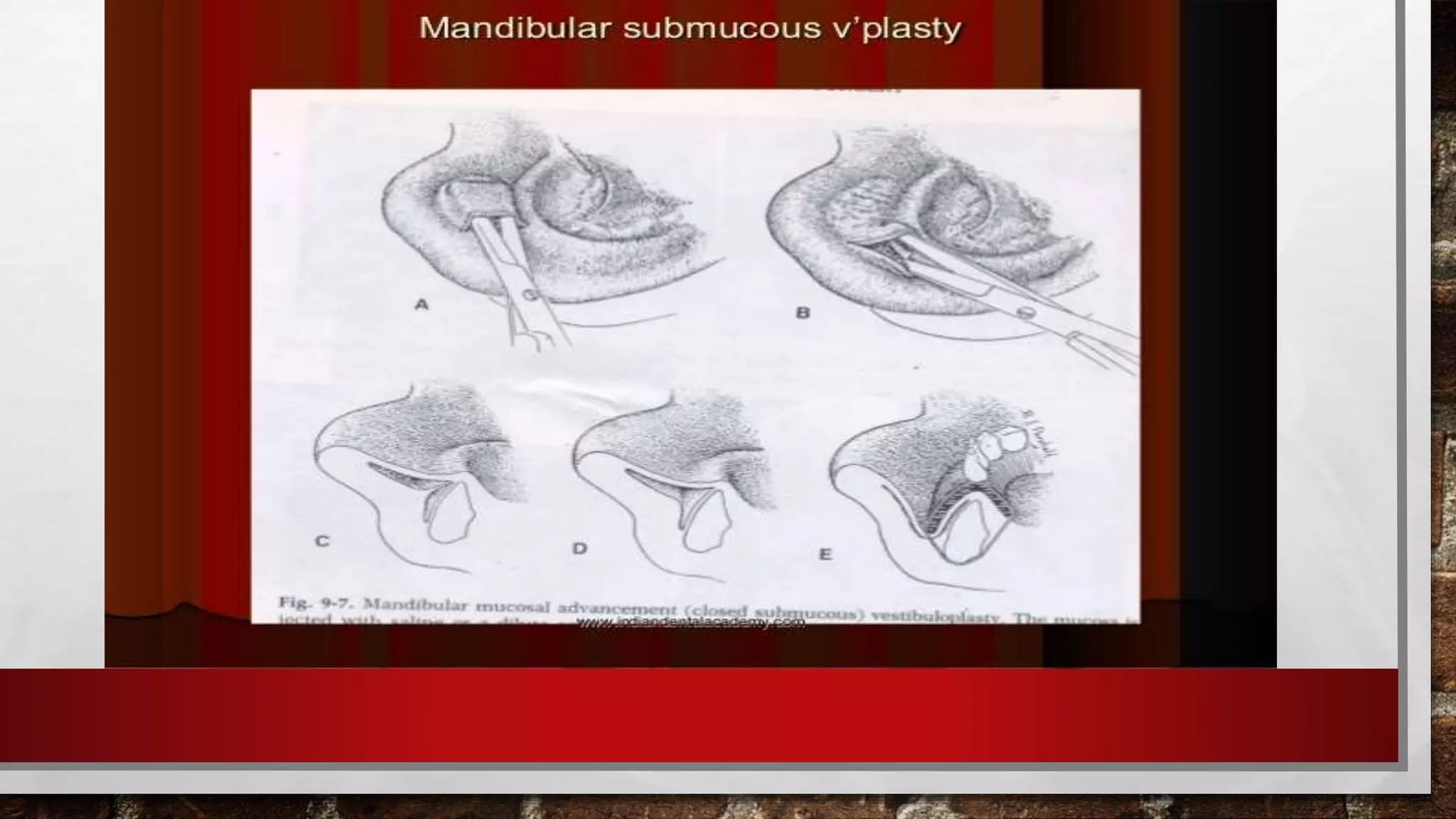 Vestibuloplasty | PPTX
