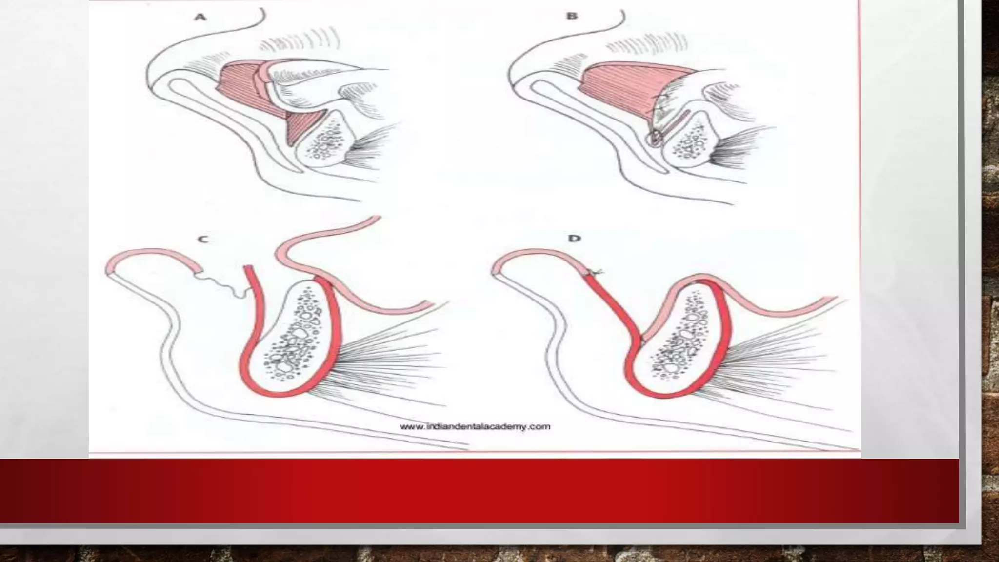 Vestibuloplasty | PPTX
