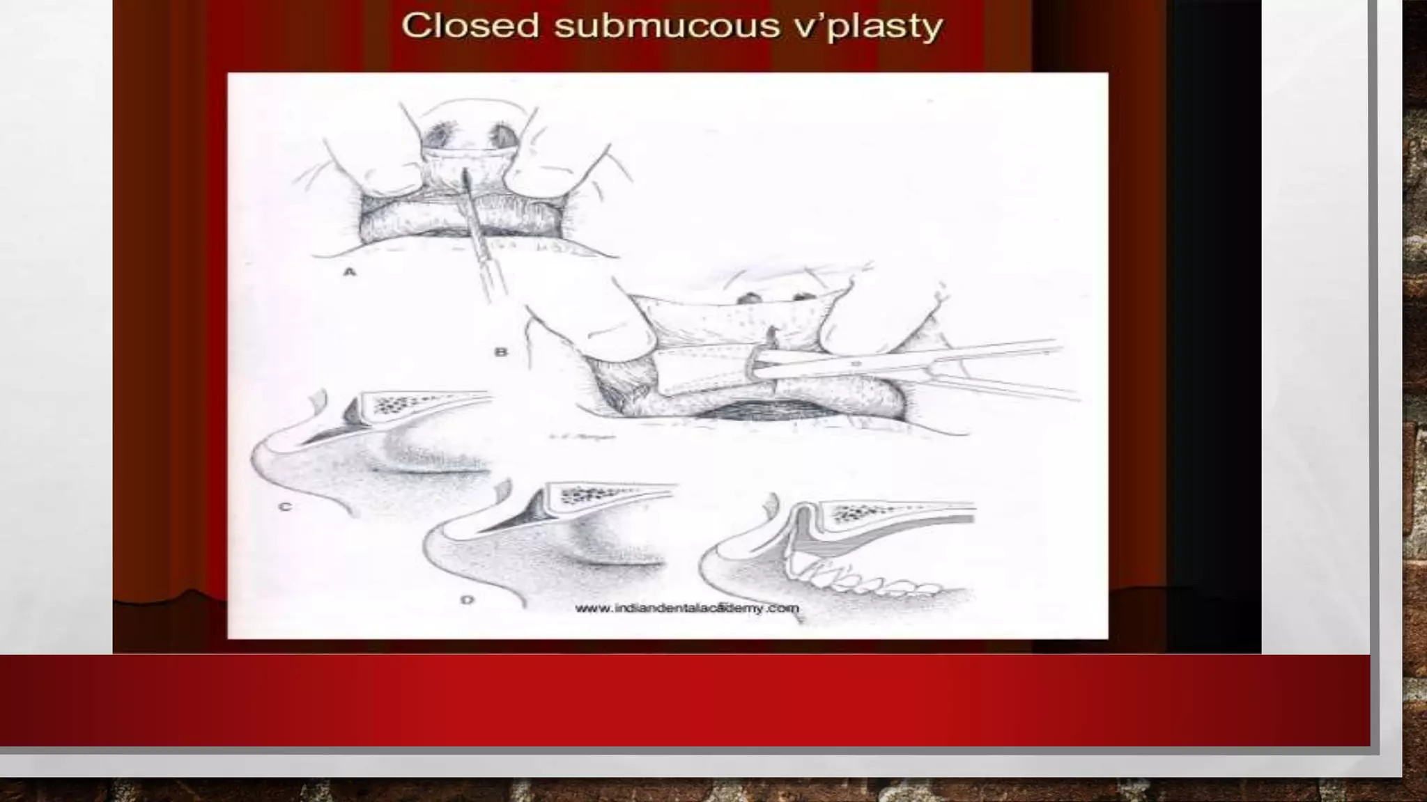 Vestibuloplasty | PPTX