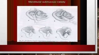 Vestibuloplasty | PPTX