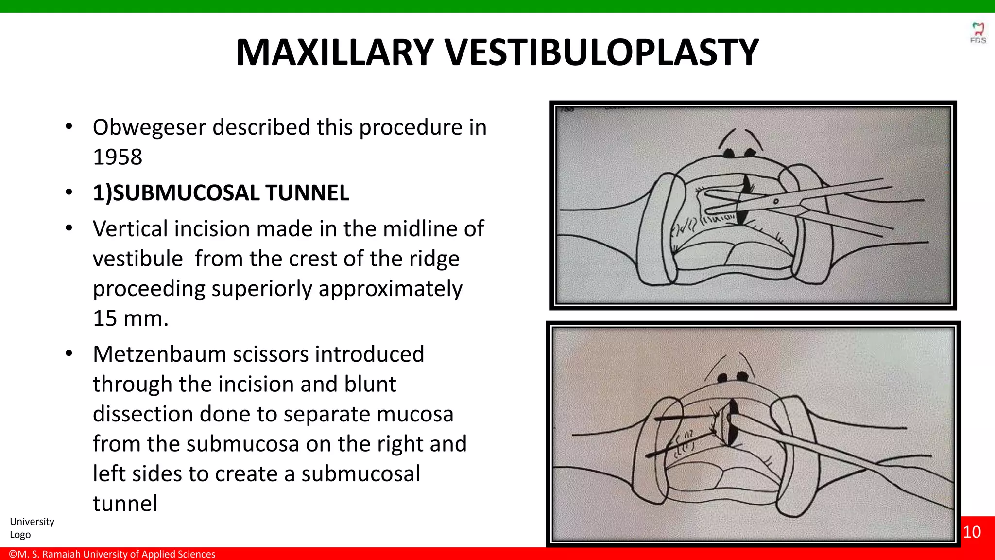 Vestibuloplasty- ridge extension procedures | PPTX