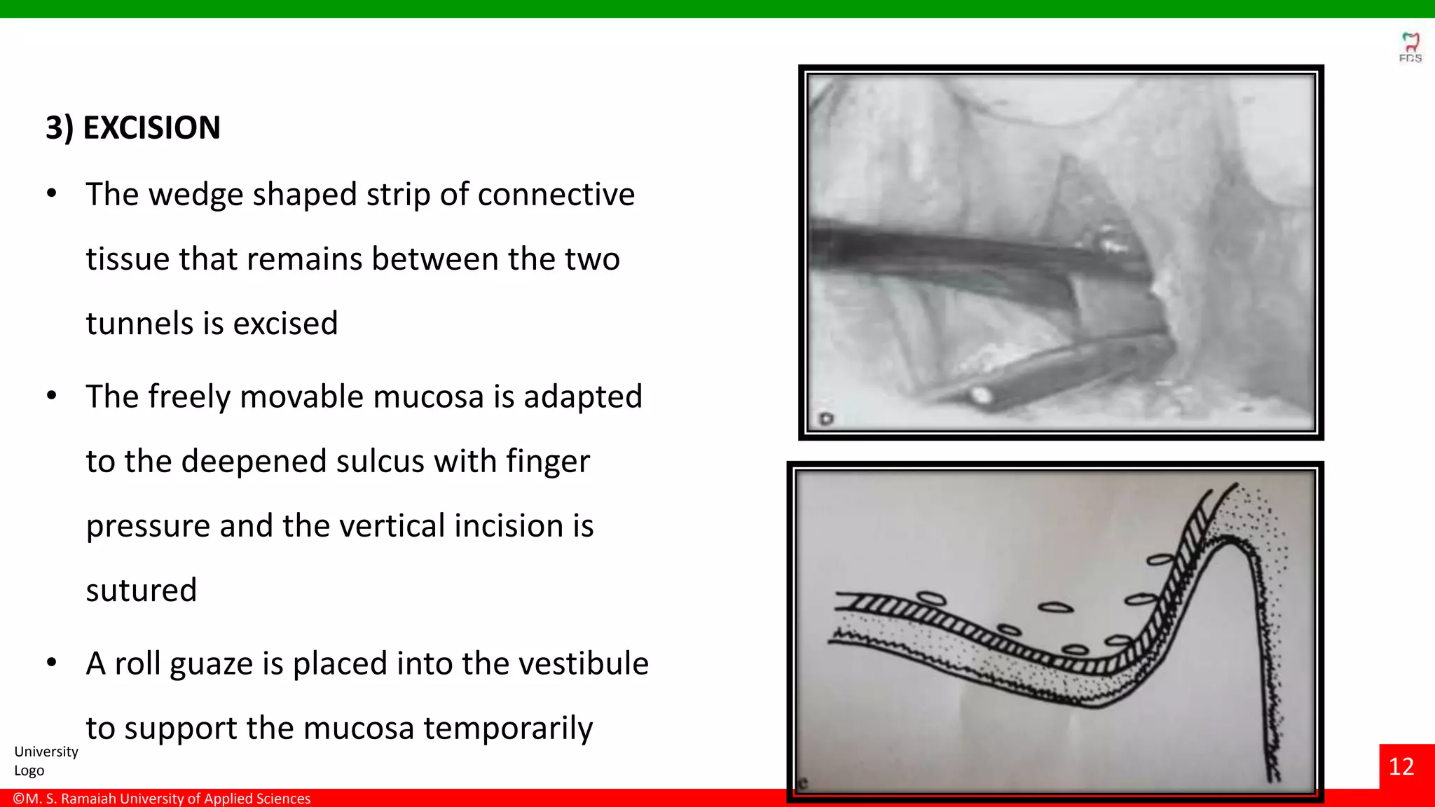 Vestibuloplasty- ridge extension procedures | PPTX