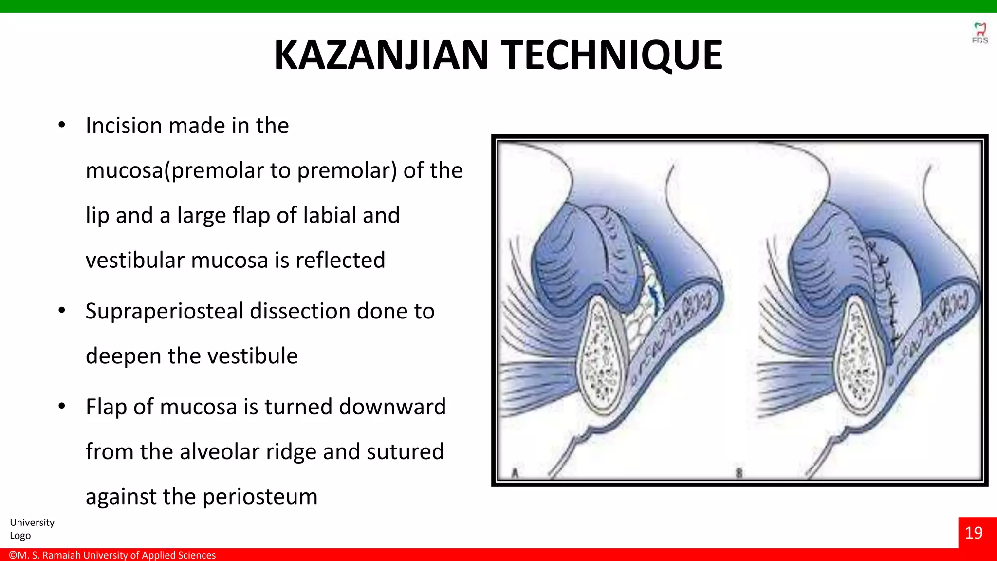 Vestibuloplasty- ridge extension procedures | PPTX