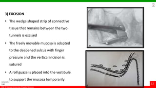 Vestibuloplasty- ridge extension procedures | PPTX