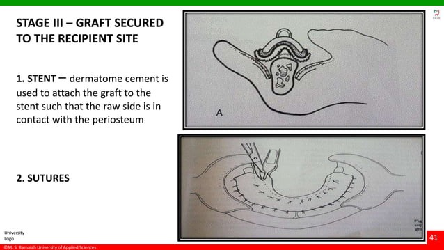 Vestibuloplasty- ridge extension procedures | PPTX